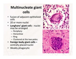 granuloma inflammation powerpoint presentation | PPTX