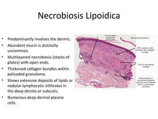 Granuloma annulare 2.0 | PPT