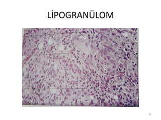Non- Infectious Granuloma and Granuloma Annulare | PPT