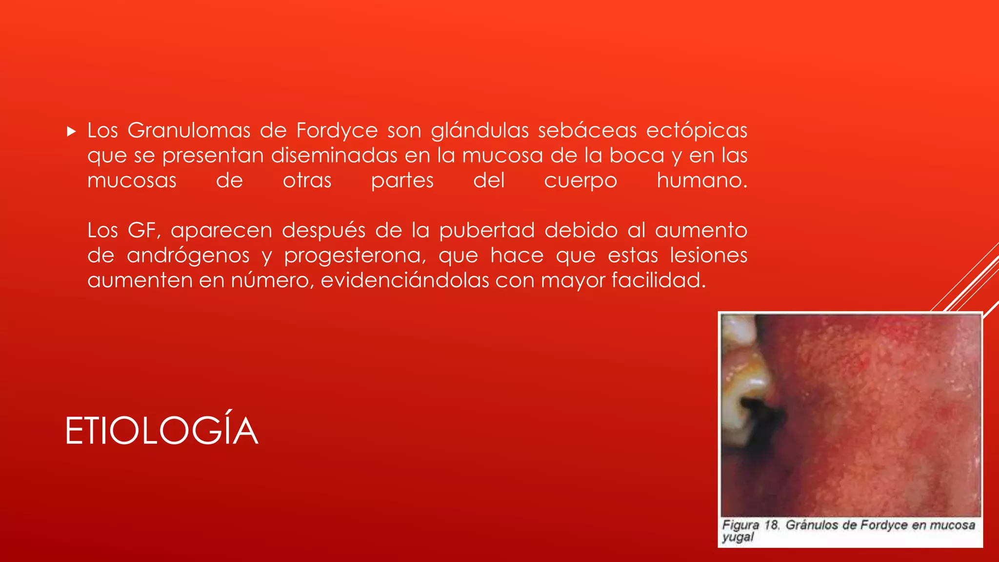 Granulomas de Fordyce | PPTX