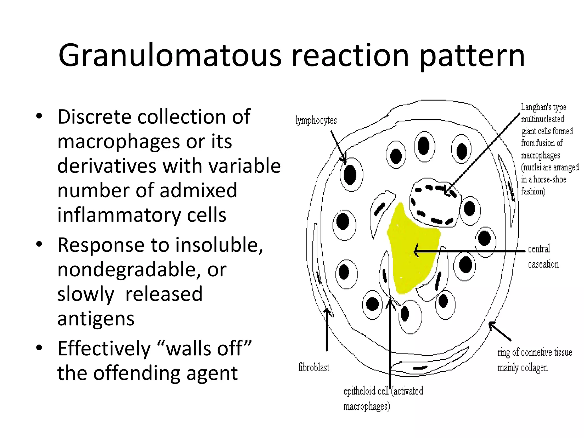 Granulomas Dr Manasa Shettisara Janney | PPTX