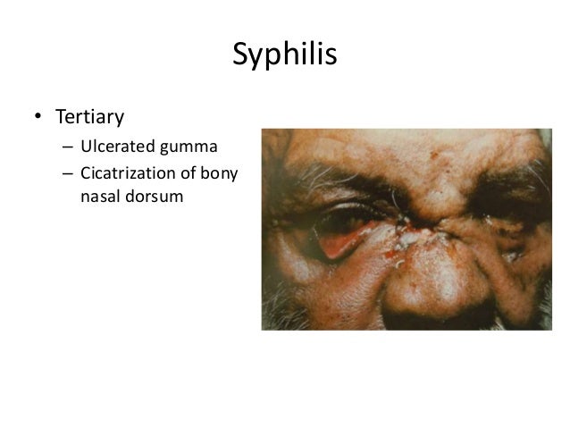 Granulomatous diseases in ENT