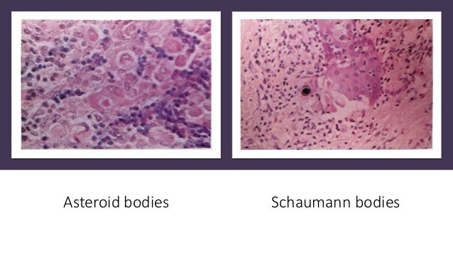 Granulomatous disease (Tuberculosis & Sarcoidosis)