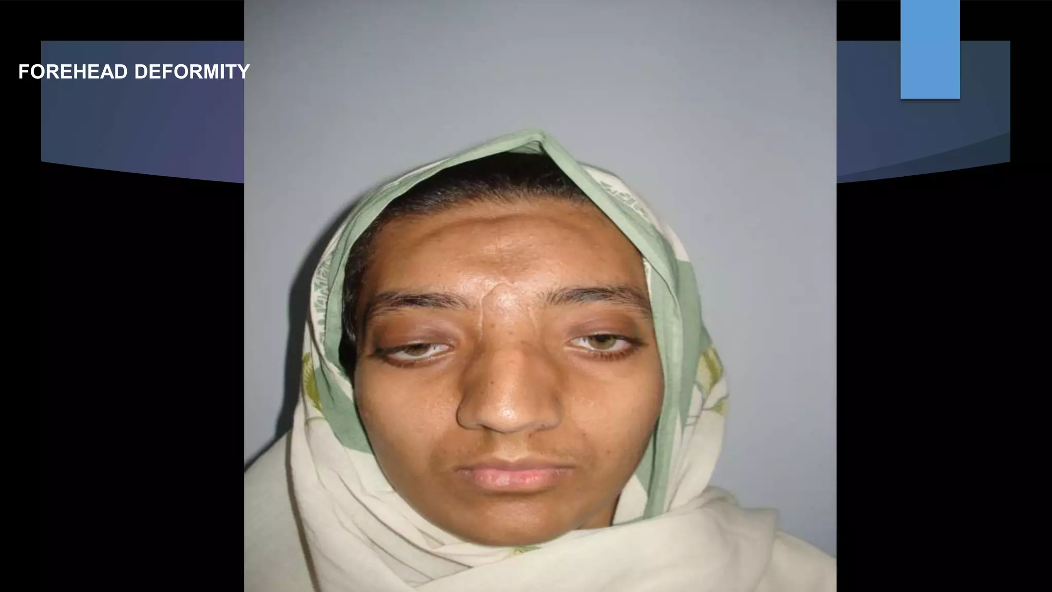 Granulomatous disease of nose | PPTX