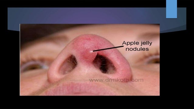 Granulomatous disease of nose