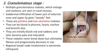 Granulomatous diseases of nose | PPTX
