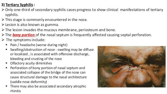 Granulomatous diseases of nose