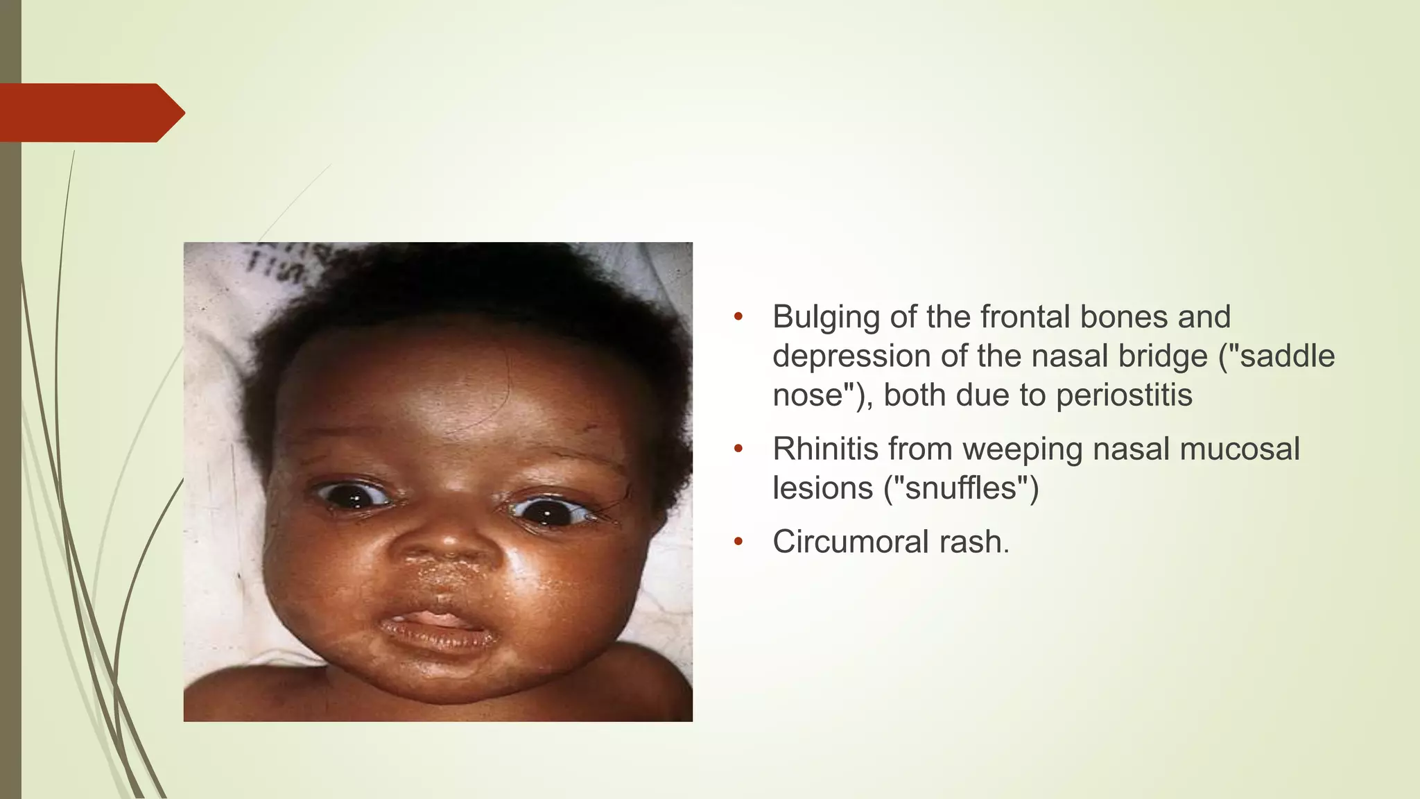 Granulomatous diseases of nose | PPTX