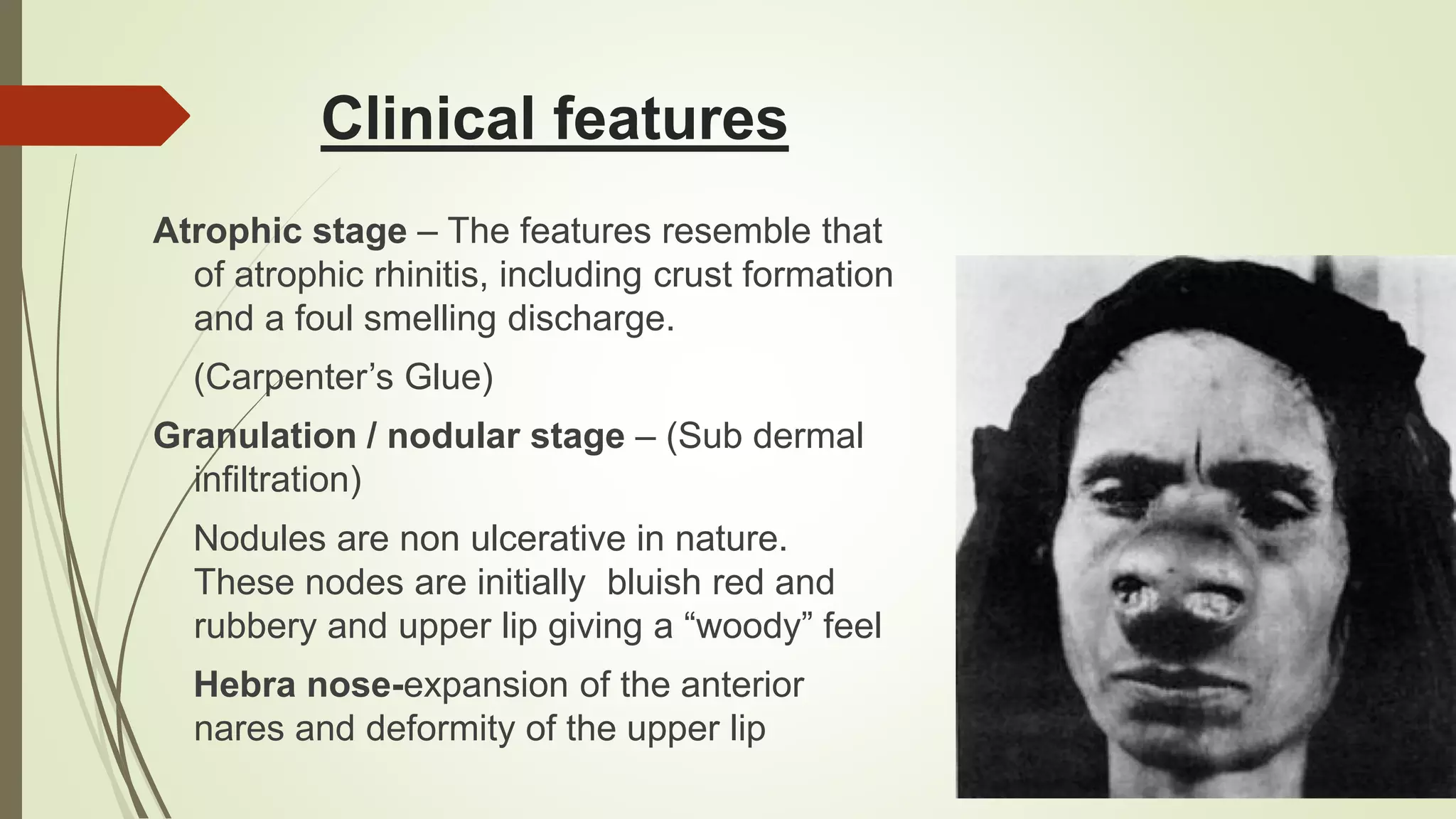 Granulomatous diseases of nose | PPTX
