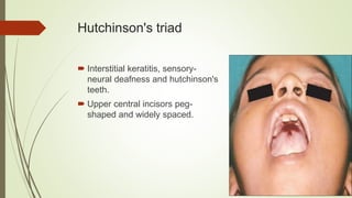 Granulomatous diseases of nose | PPTX