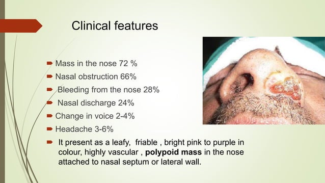 Granulomatous diseases of nose | PPTX