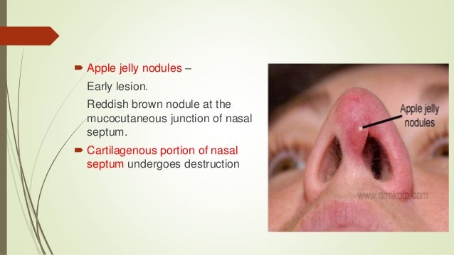 Granulomatous diseases of nose