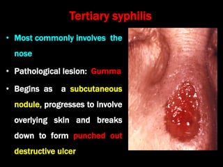 Granulomatous diseases of nose | PPT