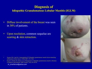 granulomatous mastitis the lect.ppt | Lung and Respiratory Health | Diseases and Conditions