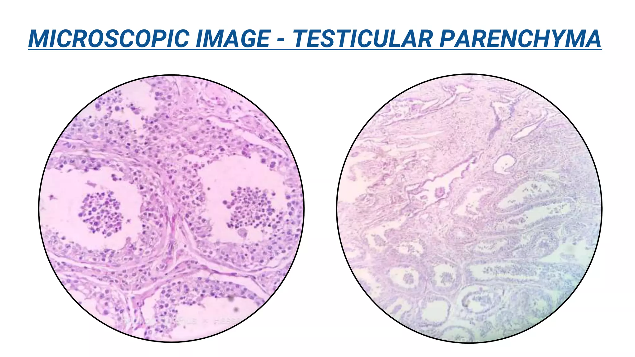 GRANULOMATOUS ORCHITIS .pptx | Medical Health