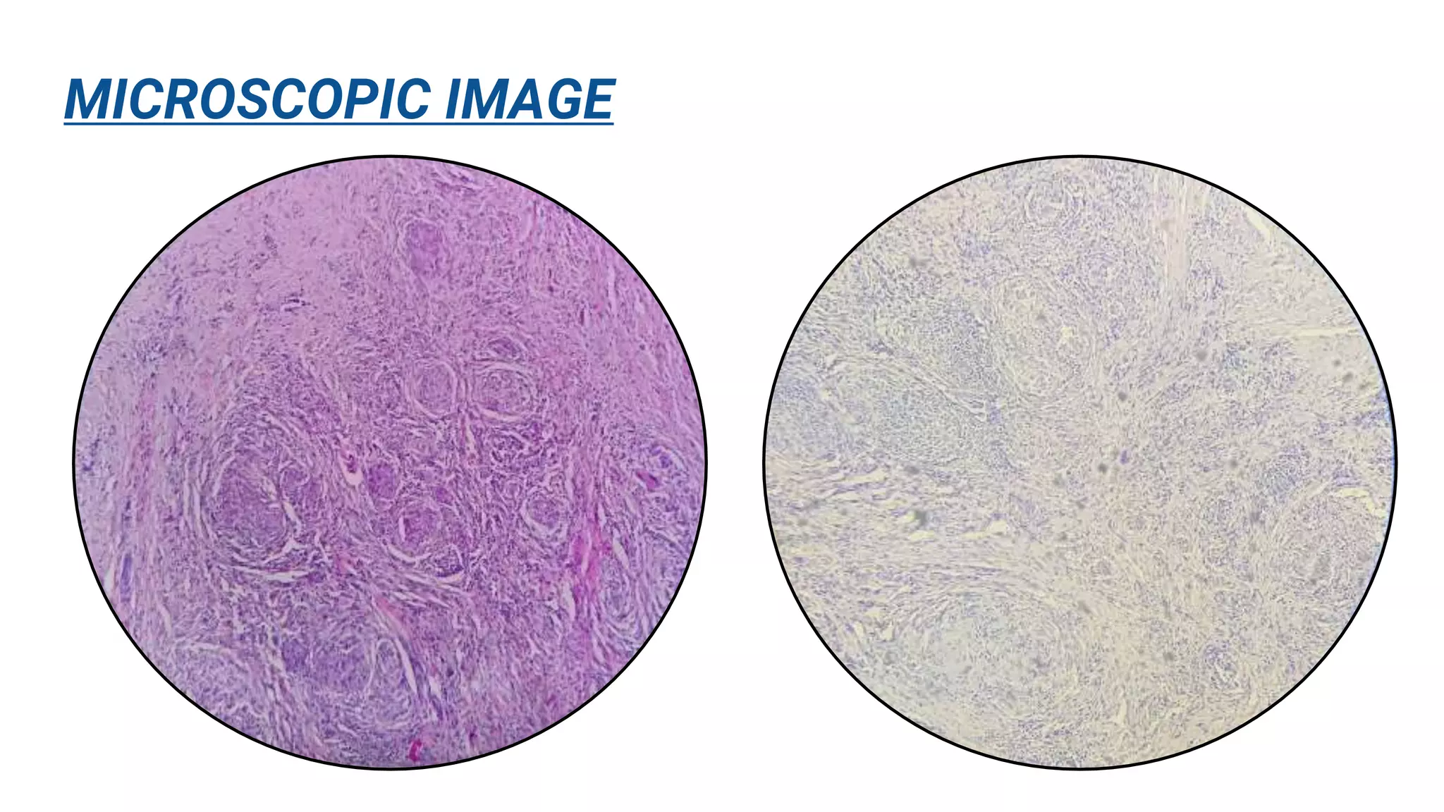GRANULOMATOUS ORCHITIS .pptx | Medical Health