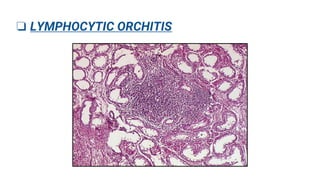 GRANULOMATOUS ORCHITIS .pptx | Medical Health
