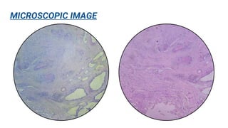 GRANULOMATOUS ORCHITIS .pptx