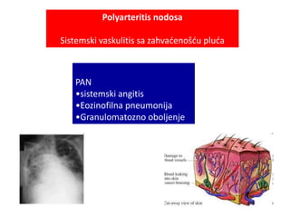 Granulomatosis presentation on powerpoint | PPT