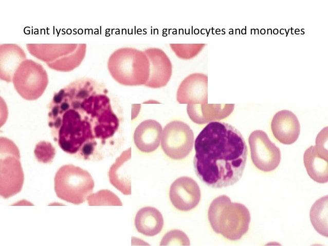 Immature Granulocytes Causes Absolute And Normal Range