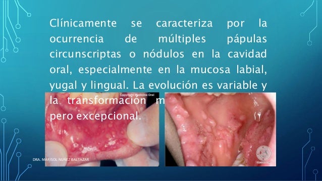 Granulos De Fordyce