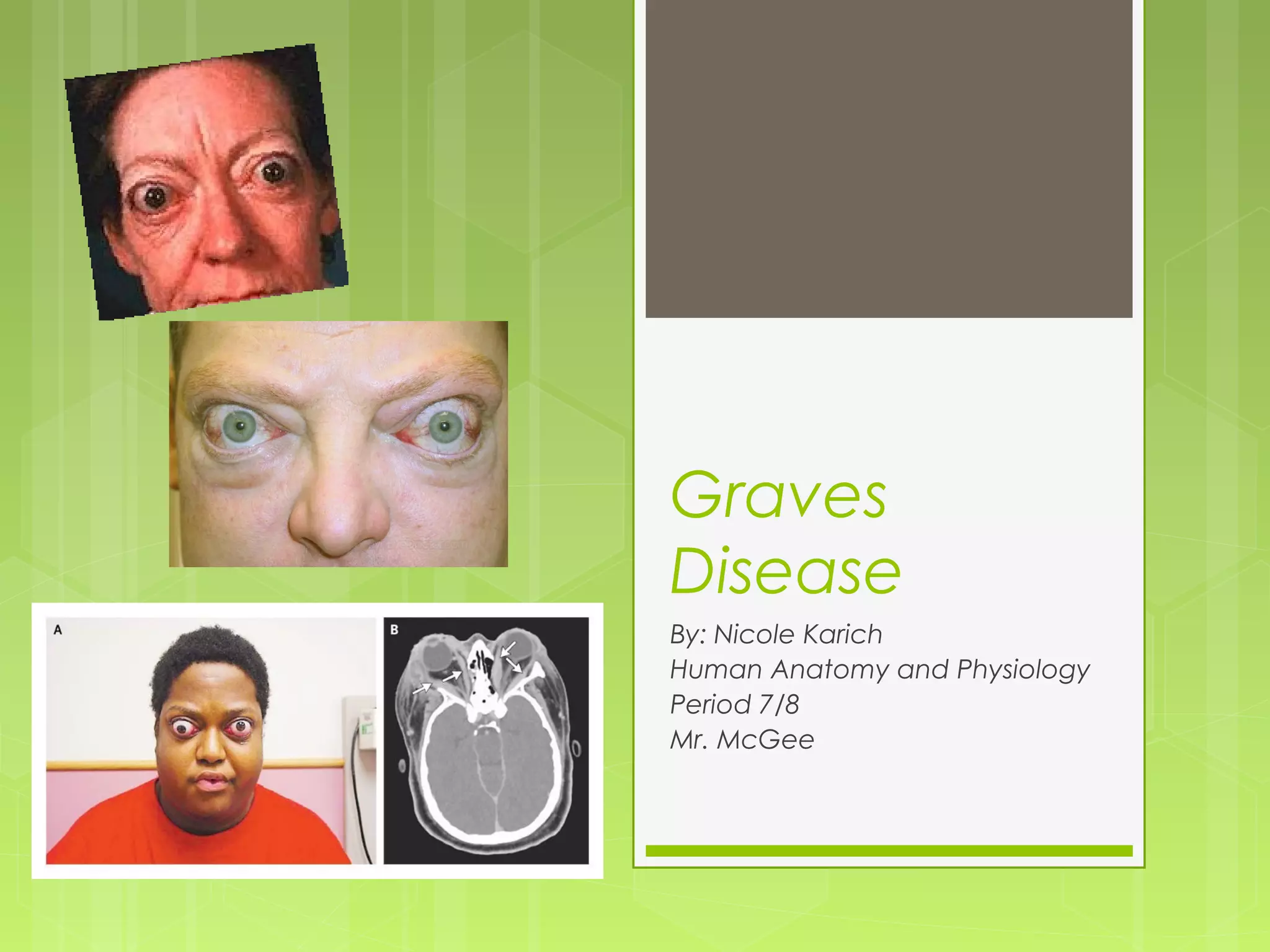 Graves disease | PPT