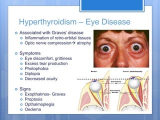 Hyperthyroidism and Grave's disease | PPTX