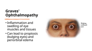 Graves' Disease Demonstrate understanding of basic concept ...