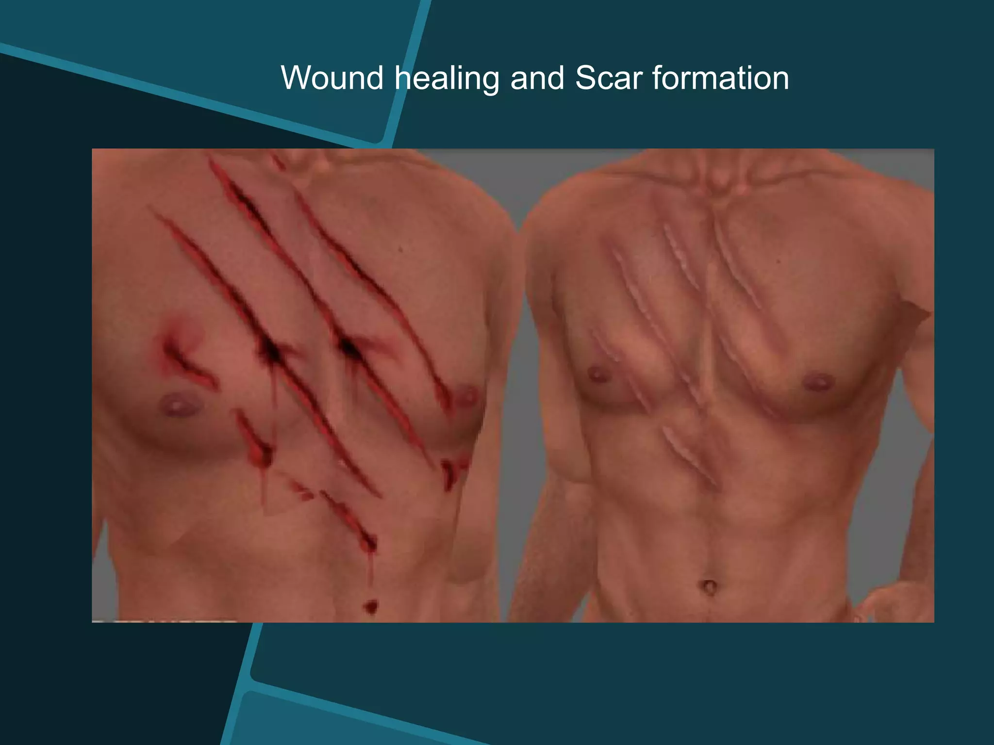 Fibrosis- Why and How? | PPTX