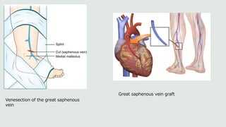 Greater Saphenous Vein Cat