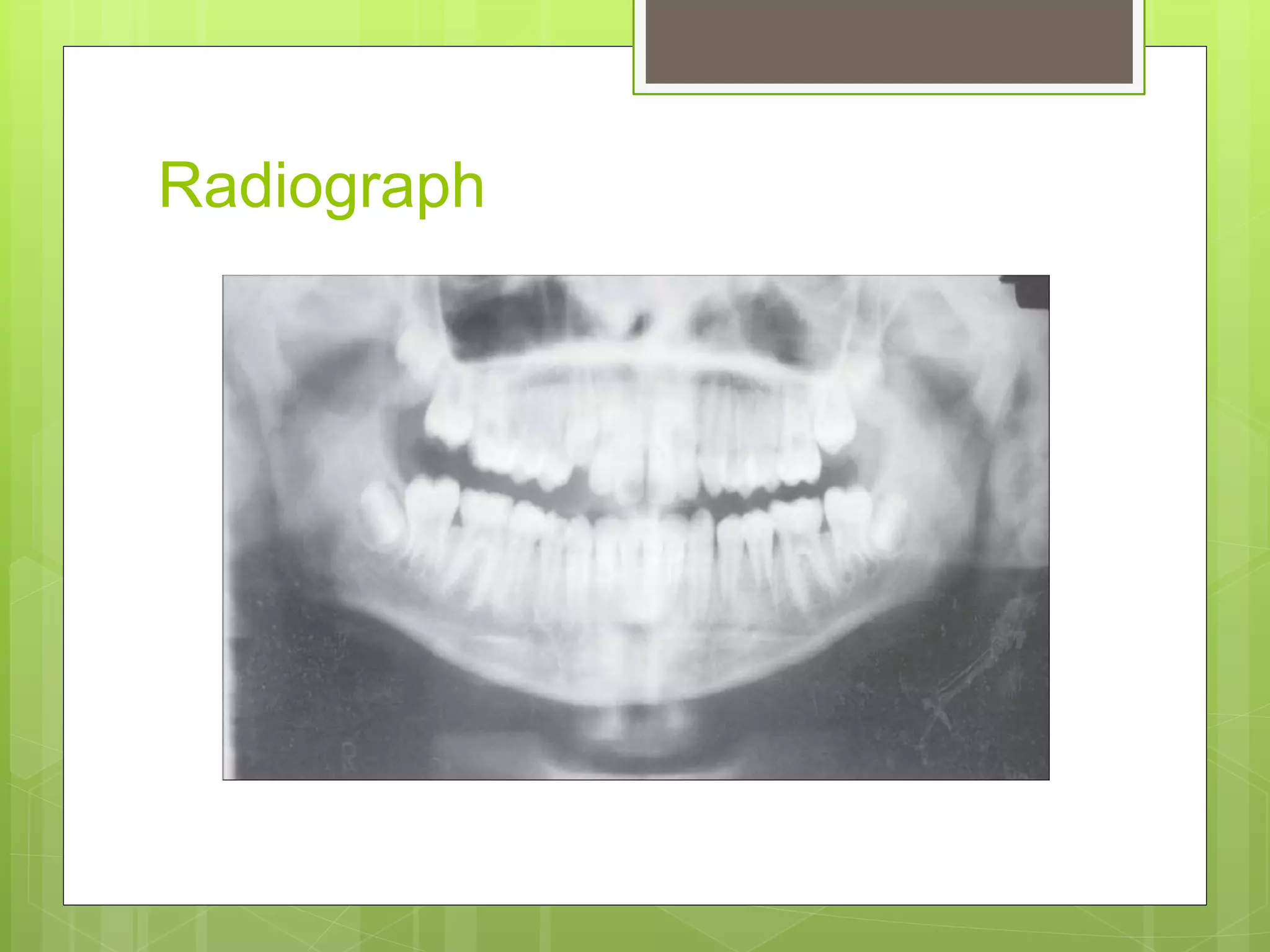 Greenstick fracture of the mandible | PPTX