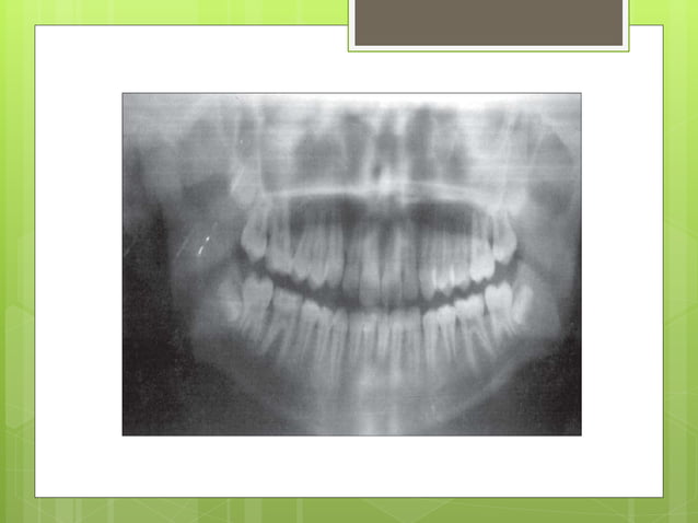 Greenstick fracture of the mandible
