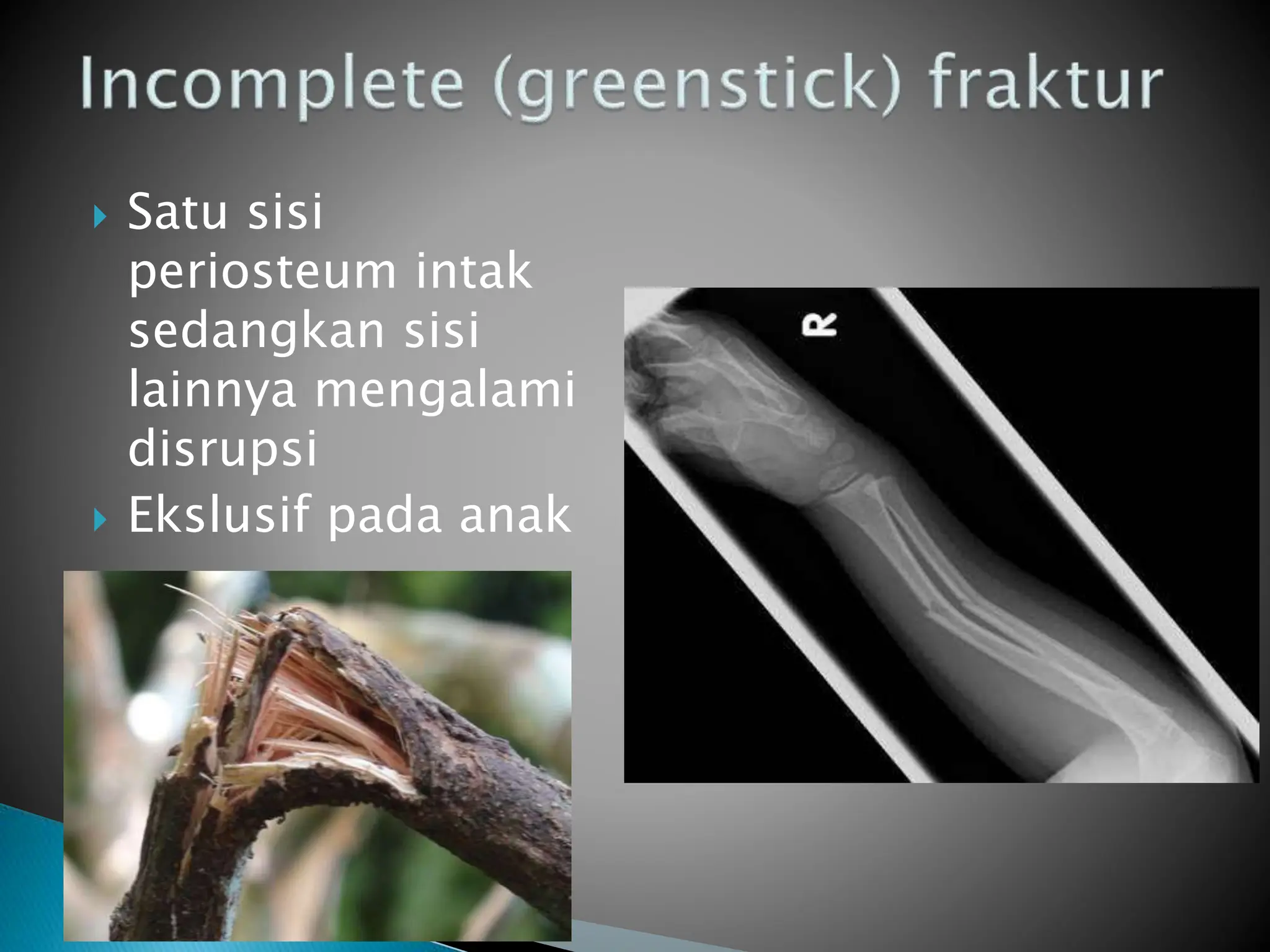 Pengenalan tentang greenstick fracture ppt.pptx