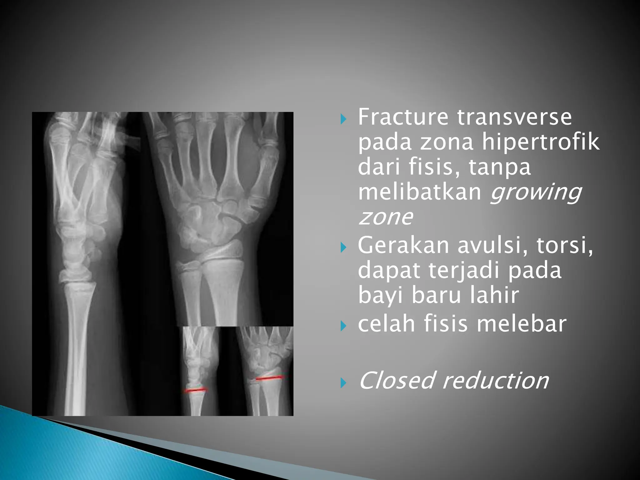 Pengenalan tentang greenstick fracture ppt.pptx