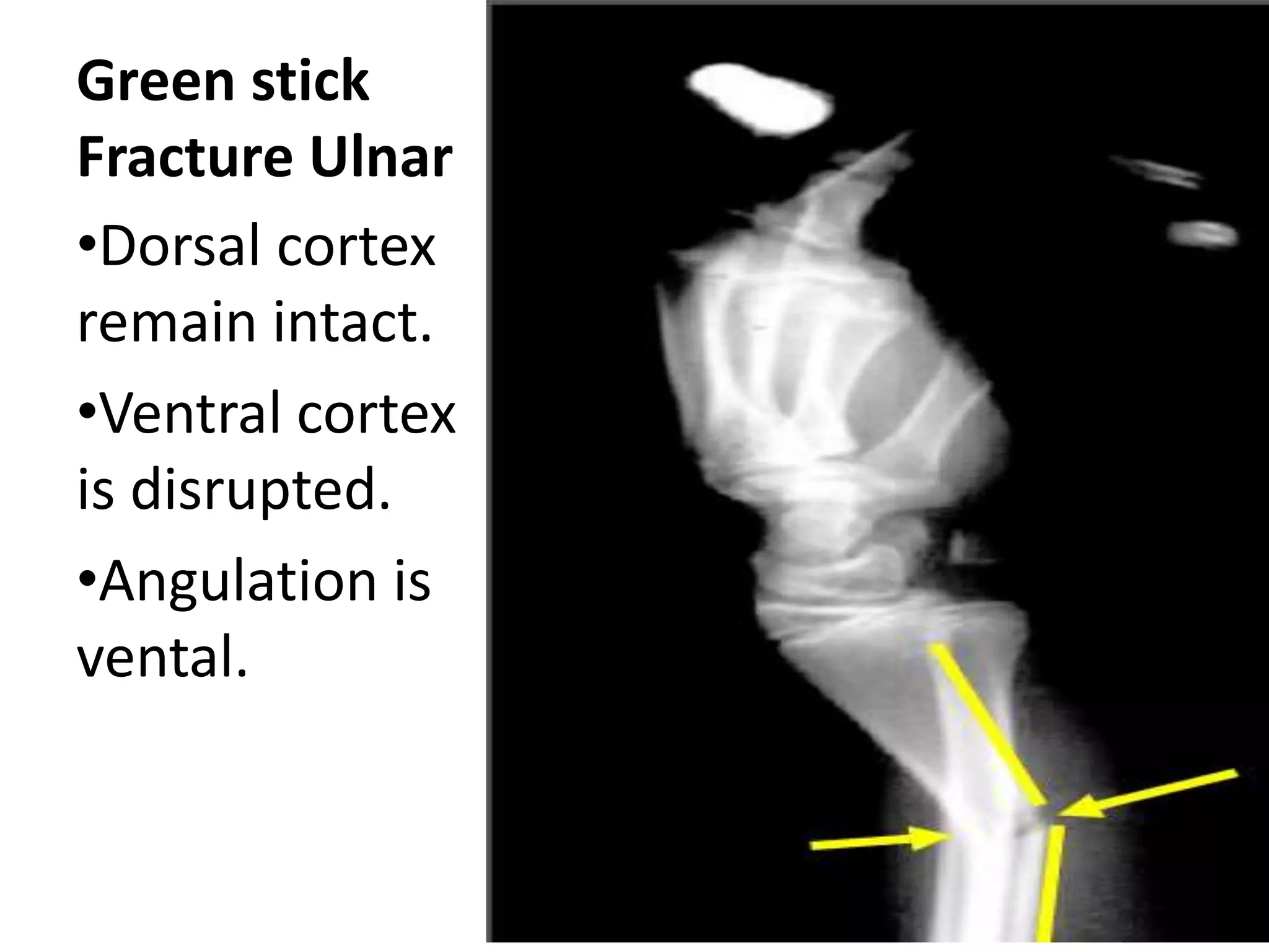 Greenstick fractures | PPTX