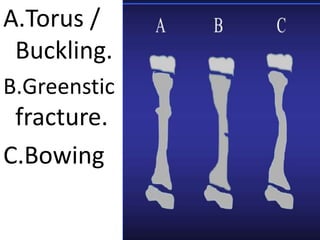 Greenstick fractures | PPTX | Death, Injury, or Military Conflict | Sensitive Topics