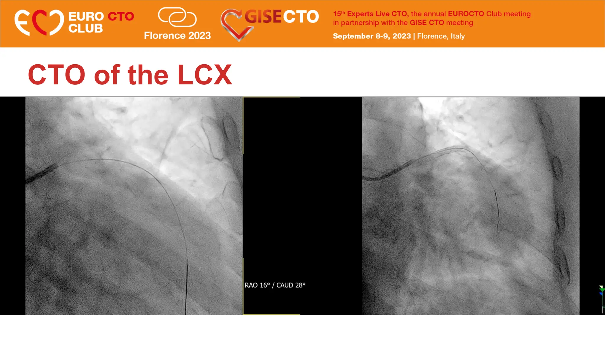 Gregor Leibundgut: Role of DEB in CTO-PCI | PDF