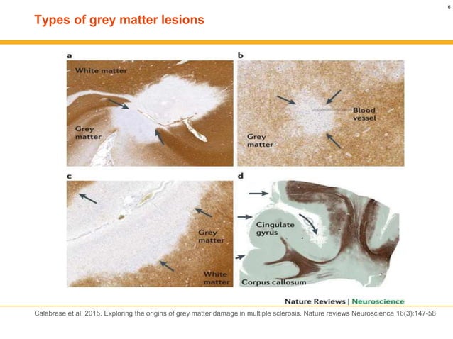 Grey matter and multiple sclerosis | PPT