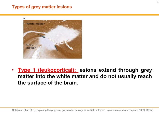 Grey matter and multiple sclerosis | PPT
