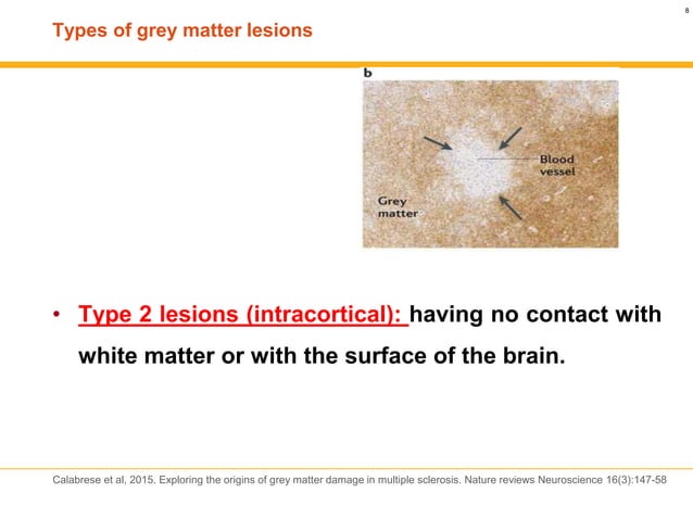 Grey matter and multiple sclerosis | PPT