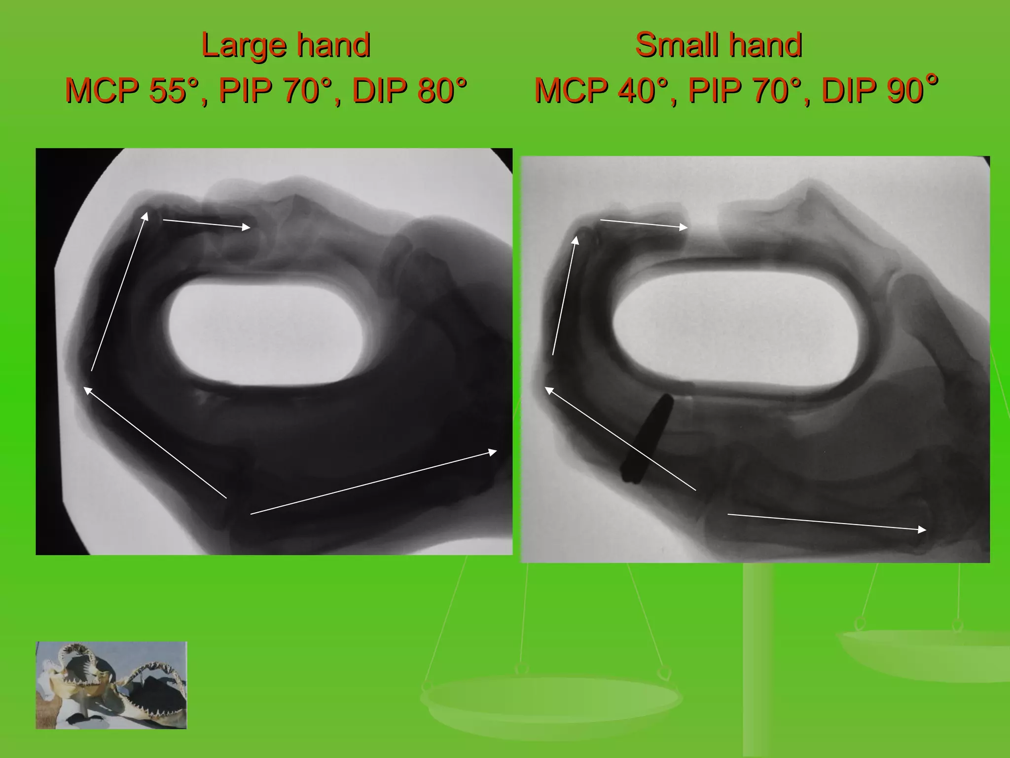 Hand Therapy - Grip Strength Measurement | PPT