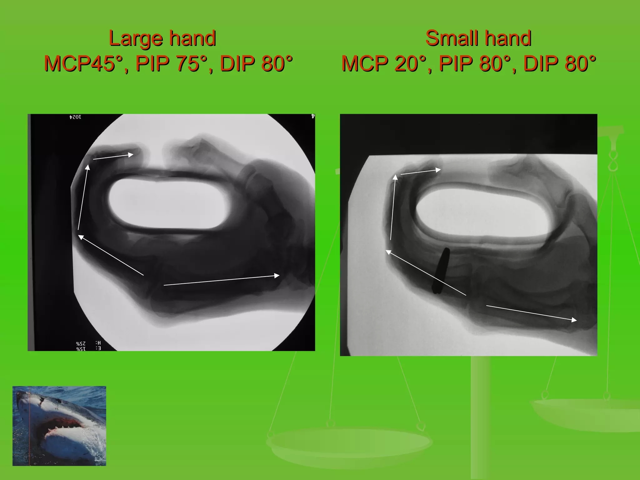 Hand Therapy - Grip Strength Measurement | PPT