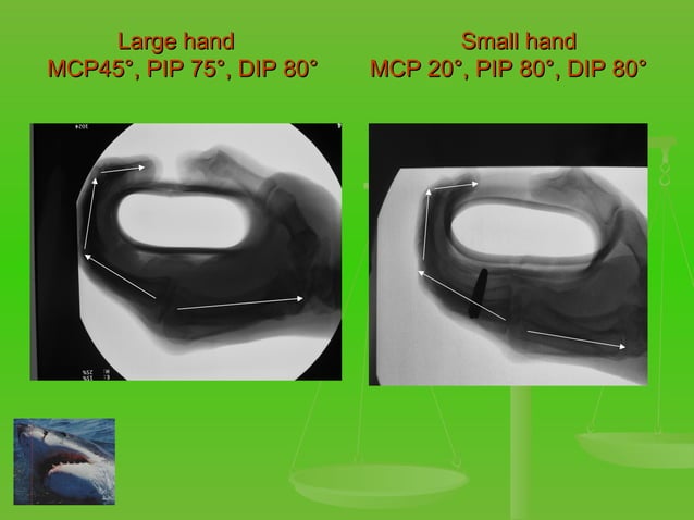 Hand Therapy - Grip Strength Measurement | PPT