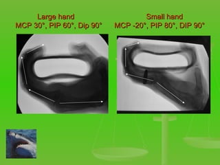 Hand Therapy - Grip Strength Measurement | PPT