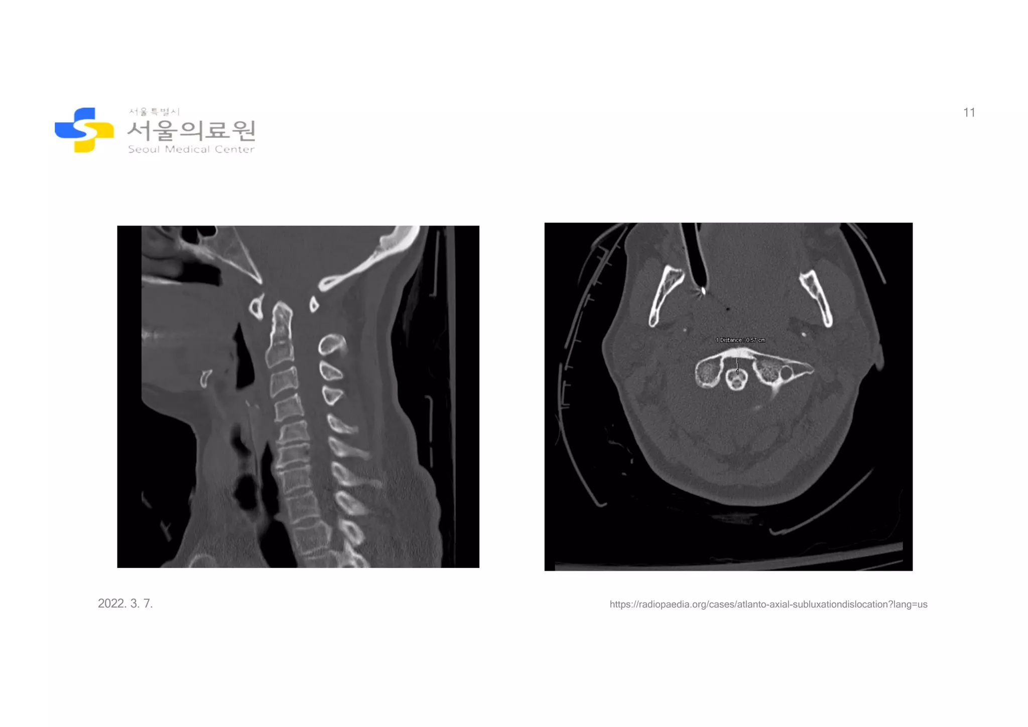 Grisel's syndrome | PDF