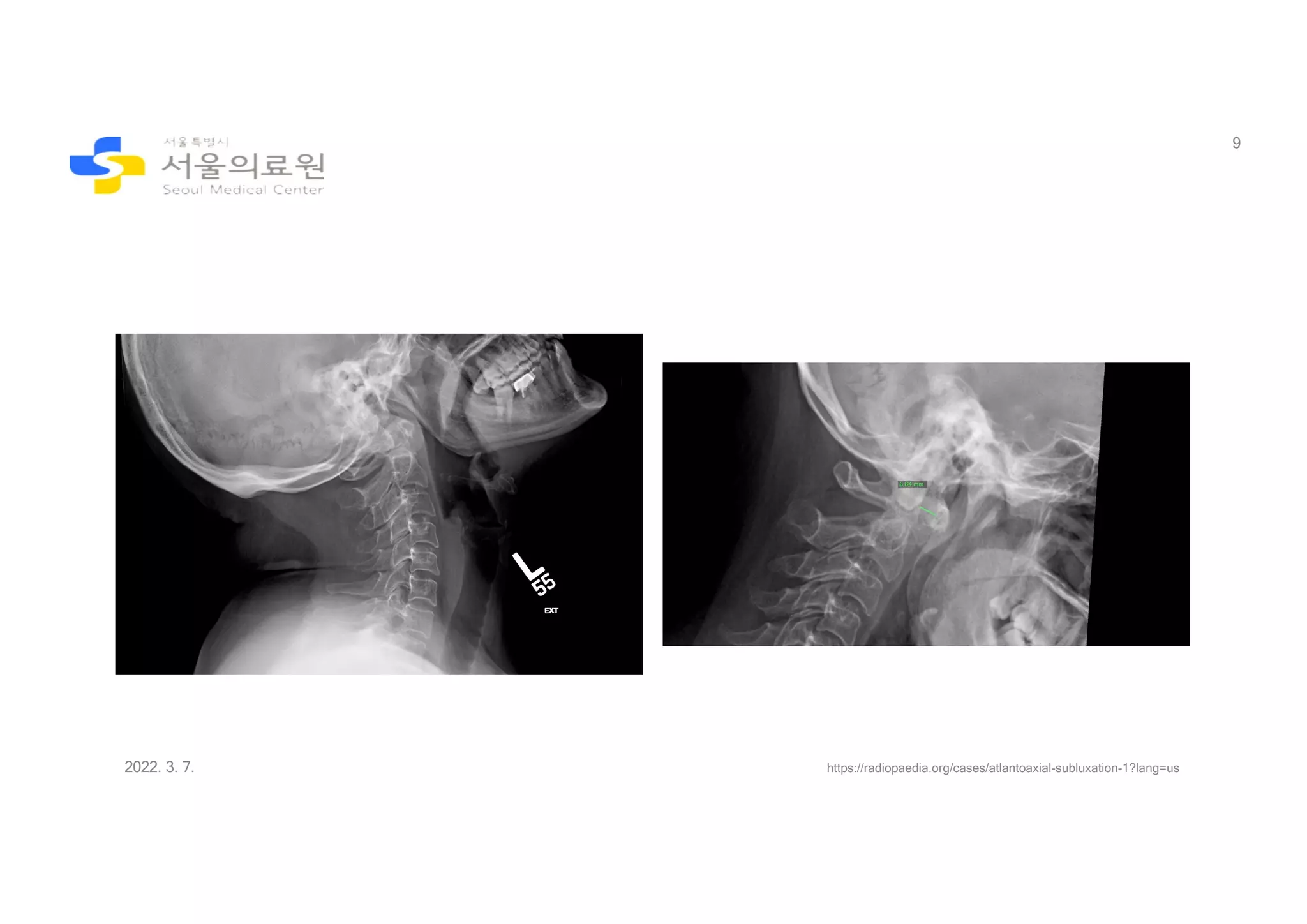 Grisel's syndrome | PDF