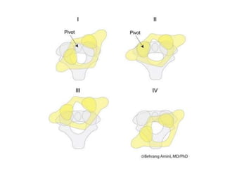 Grisel syndrome | PPTX