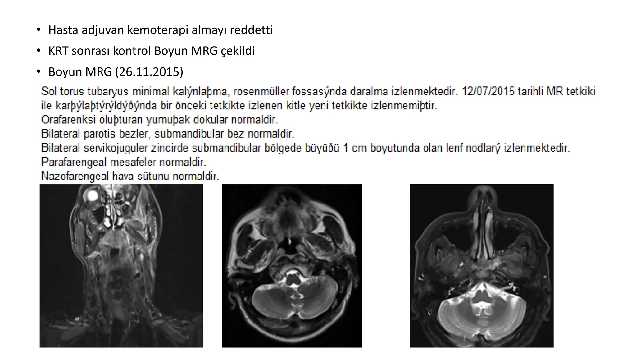 vaka sunumu nazofarenks kanseri dr.emin mammadov | PPTX