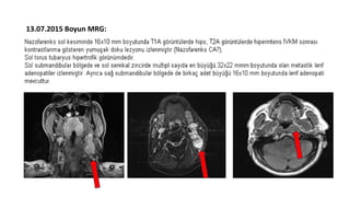 vaka sunumu nazofarenks kanseri dr.emin mammadov | PPTX