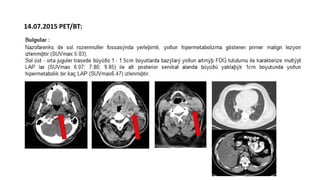 vaka sunumu nazofarenks kanseri dr.emin mammadov | PPTX